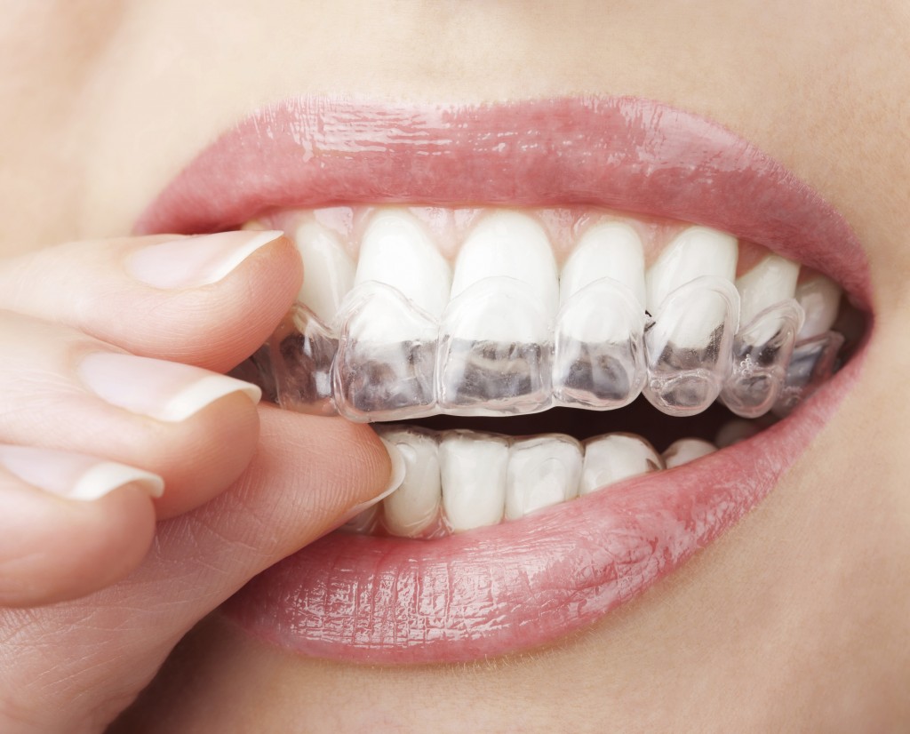 ClearCorrect Braces in Norwalk, OH - Sommers Family Dentistry Blog ...